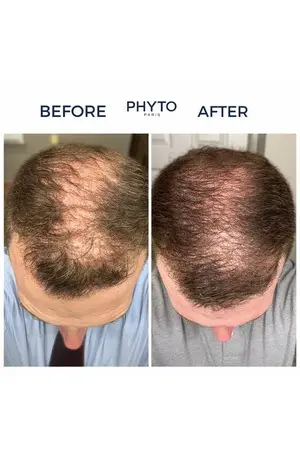 PHYTO Cyane Densifying Treatment For Progressive Hair Thinning