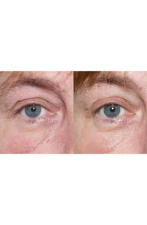 Silk'N Revit™ Microdermabrasion Device