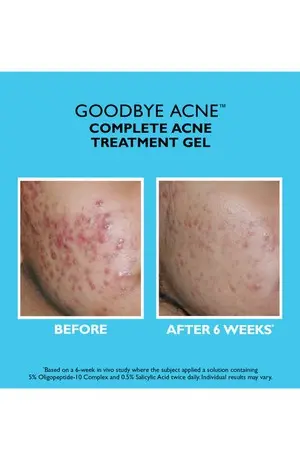 PETER THOMAS ROTH Goodbye Acne Complete Acne Treatment Gel