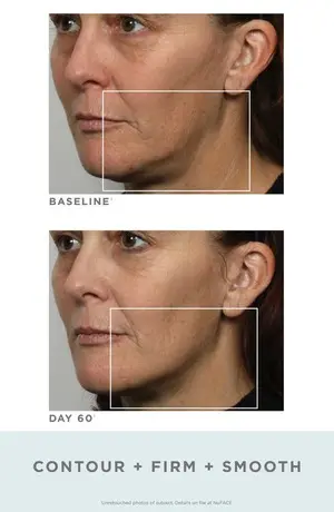 NUFACE® Trinity Facial Toning Device