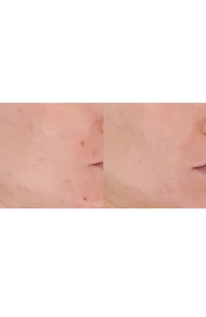 LightStim® Led Light Therapy Device For Acne