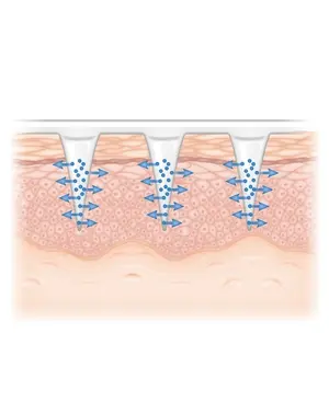 SOLARIS LABORATORIES NY Time Off Dissolving Hyaluronic Acid Microneedle Overnight Patch Treatment