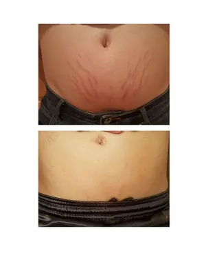 STRIALITE Stretchmark Device