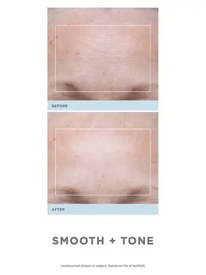 NuFACE Trinity Wrinkle Reducer