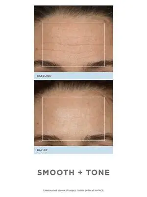 NuFACE Trinity Wrinkle Reducer
