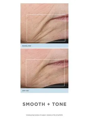NuFACE Trinity Wrinkle Reducer