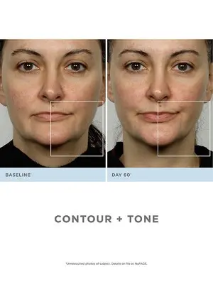 NuFACE Trinity Facial Toning Device Set