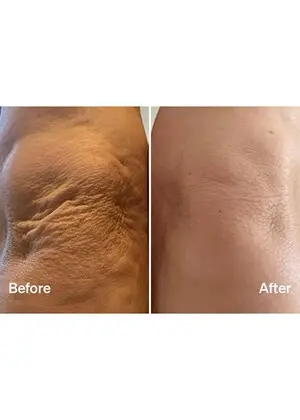 LYMA Laser Mist & Glide Refill Days - 60