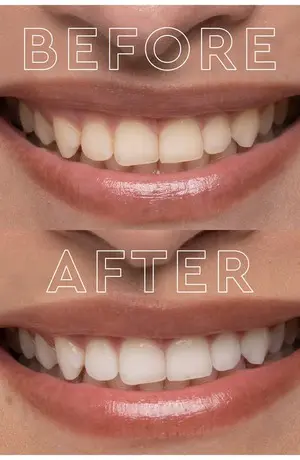 MOON The Teeth Whitening Device System
