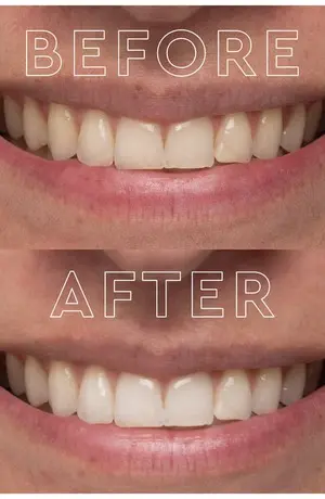 MOON The Teeth Whitening Device System