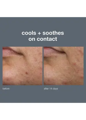 DERMALOGICA Liquid Patch Acne Treatments, Breakout Help - Deep