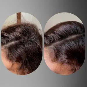 ACT+ACRE Cold Processed Scalp Renew Treatment