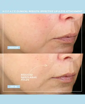NuFACE Effective Lip & Eye Attachment - No Color