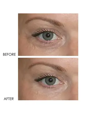 DERMELECT Revitalite Professional Eyelid & Dark Circle Corrector - Open Miscellaneous
