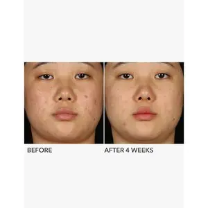 DR. DENNIS GROSS SKINCARE Alpha Beta 2% Bha+ Liquid Solution