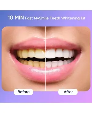 MYSMILE Deluxe 10 Min Teeth Whitening Kit With 28 Led Light - White