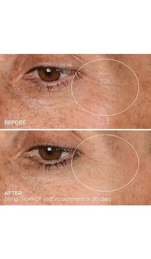 BEAUTYBIO Glopro Eye Microtip Attachment