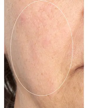 PERRICONE MD Hp Intensive Smoothing Serum