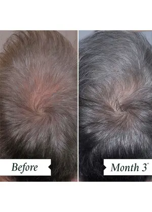 PHILIP KINGSLEY Density Preserving Scalp Drops - N/a