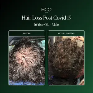 EXOCEUTICALS Exo Activate Follicle Enrichment Serum