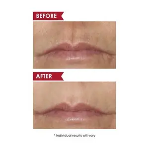 DERMELECT Smooth Upper Lip Professional Perioral Anti-aging Treatment - White