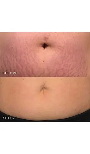 DERMACLARA Belly & Body Occlusion Patch