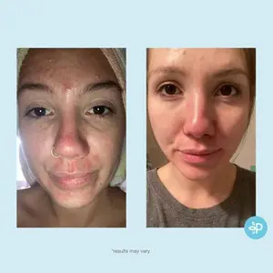 PERFECT IMAGE Glycolic 30% Gel Peel 1oz