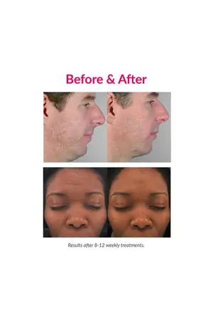Pmd Personal Microderm Elite Pro Exfoliation Device - Sky