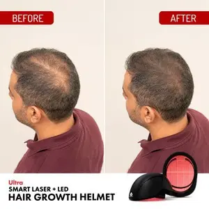 PURSONIC Ultra Smart Laser & Led Hair Growth Helmet552 Precision Light Emitters