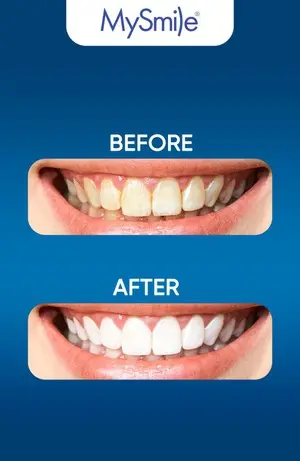 MYSMILE 5x Original Accelerated Teeth Whitening Led Light - Blue