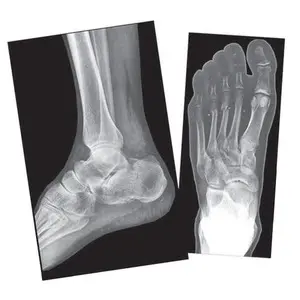 ROYLCO Broken Bones X-rays