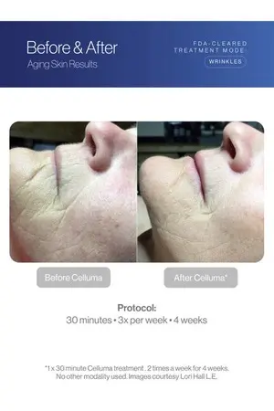 CELLUMA Nova Led Light Therapy