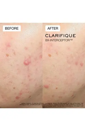 LANCOME Clarifique Bx-interceptor Acne Treatment With Glycolic & Salicylic Acid - No Color