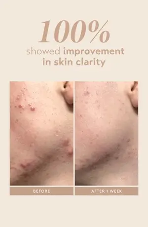 SHANI DARDEN SKINCARE Rescue Serum With 10% Azelaic Complex