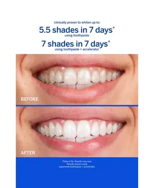 SUPERSMILE Wild Mint Whitening System With Fluoride, Professional Grade 2-step Whitening Toothpaste And Accelerator