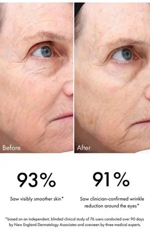 NIRA BEAUTY MISC Pro 3 & Precision 2-piece Laser Setanti-aging Wrinkle Reduction