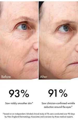 NIRA BEAUTY MISC Precision Lasereye Wrinkle & Fine Line Device
