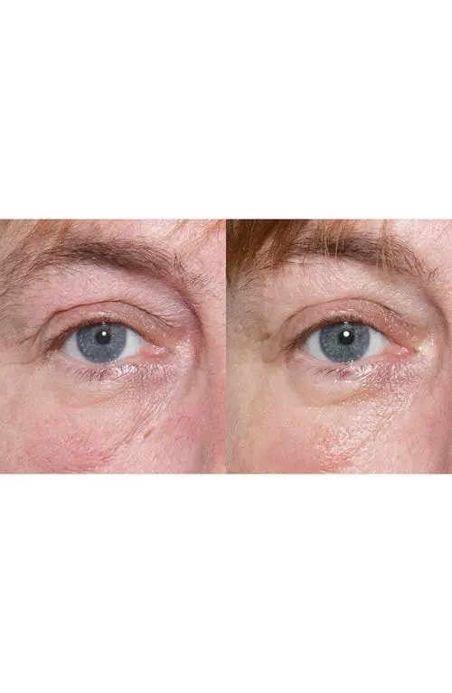 Silk'N Revit™ Microdermabrasion Device