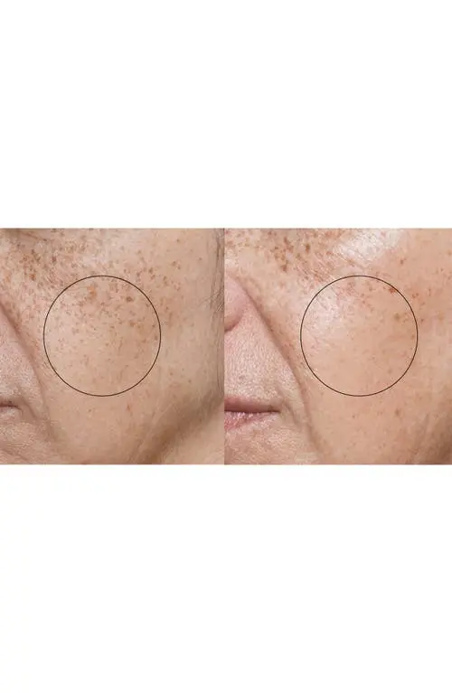 Silk'N Revit™ Microdermabrasion Device