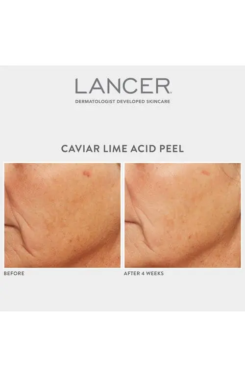 LANCER SKINCARE Caviar Lime Acid Peel - No Color