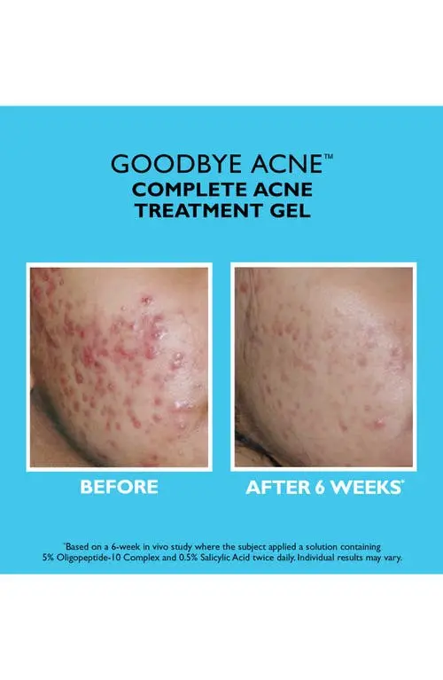 PETER THOMAS ROTH Goodbye Acne Complete Acne Treatment Gel