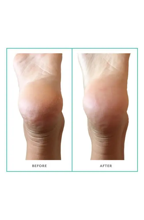 PATCHOLOGY Poshpeel™ Pedi Cure Foot Treatment Peel - No Color