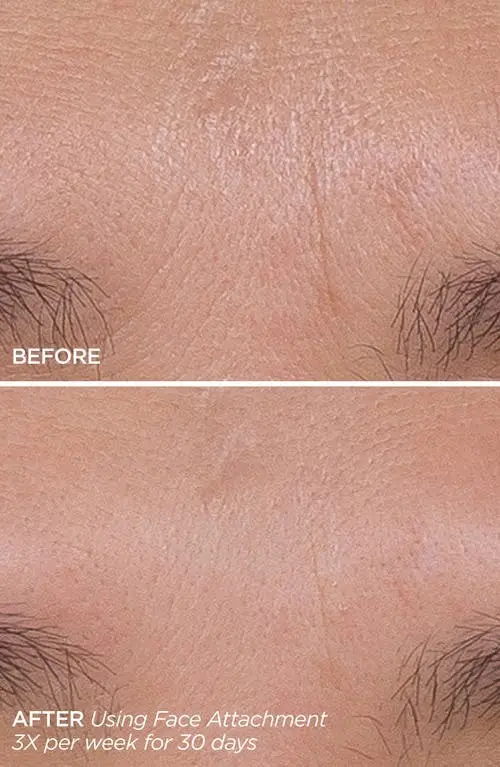 BEAUTYBIO Glopro® Face Microtip™ Attachment Replacement Head