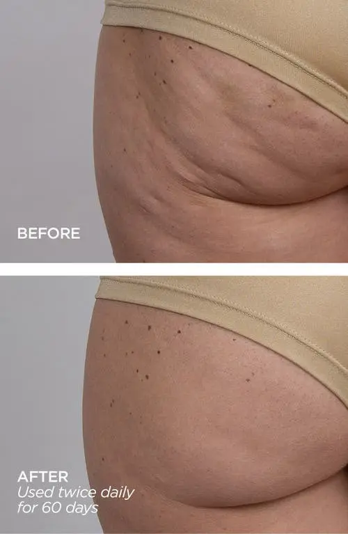 BEAUTYBIO Glopro® Body Microtip™ Attachment & Body Cream Set