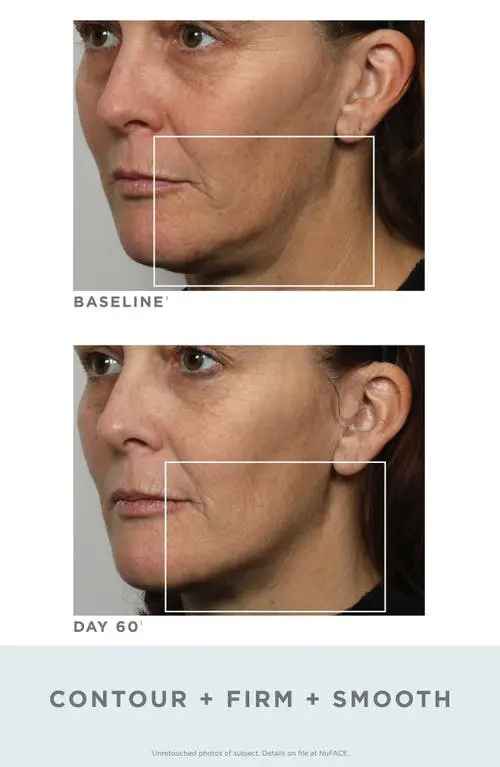 NUFACE® Trinity Facial Toning Device
