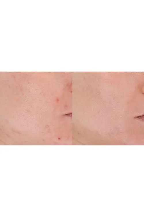 LIGHTSTIM® For Acne Led Light Therapy Device