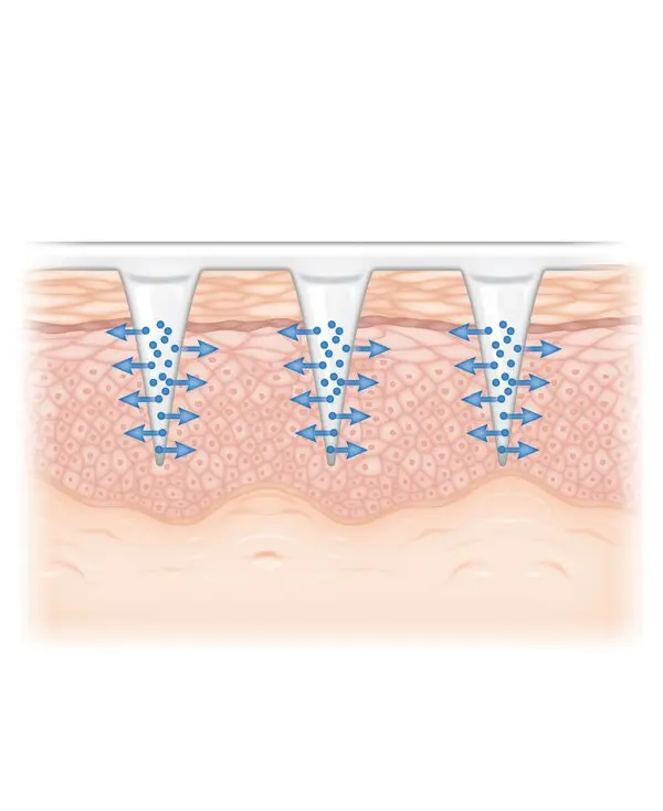 SOLARIS LABORATORIES NY Time Off Dissolving Hyaluronic Acid Microneedle Overnight Patch Treatment