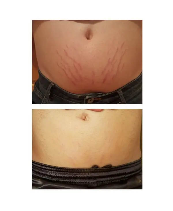 STRIALITE Stretchmark Device