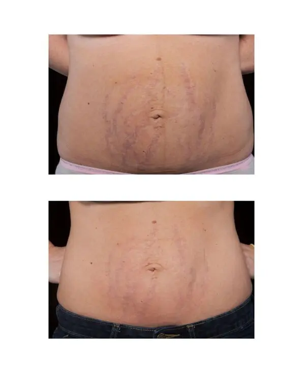 STRIALITE Stretchmark Device