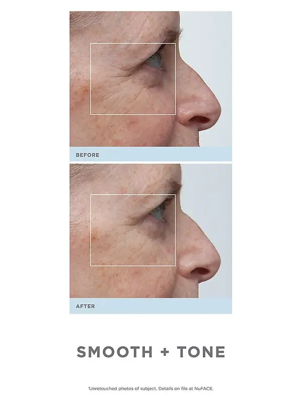 NuFACE Trinity Wrinkle Reducer